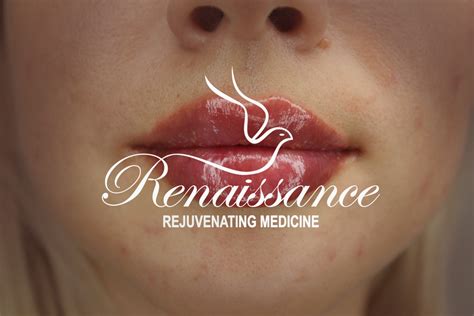 Youre Invited 🥰 Join Us For Our Toxin Party On November 15th For The