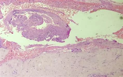 Non Sexually Acquired Genital Ulceration ISGE