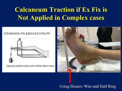 Proximal Tibia Fractures And Its Management Pptx Proximal Tibia Fractures And Its Management Pptx