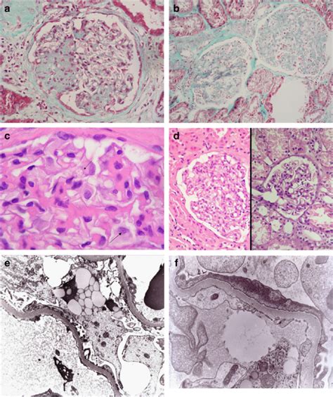 Focal And Segmental Glomerulosclerosis Two Peripheral Sclerotic Download Scientific Diagram