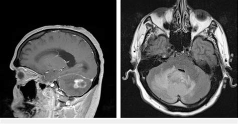 Mri Of The Brain Revealed A 26 Cm Cerebellar Lesion Download