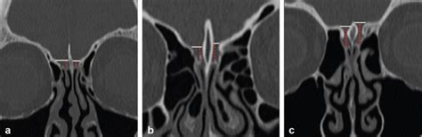 Representative Cases Of Keros Classification A Olfactory Fossa With Download Scientific
