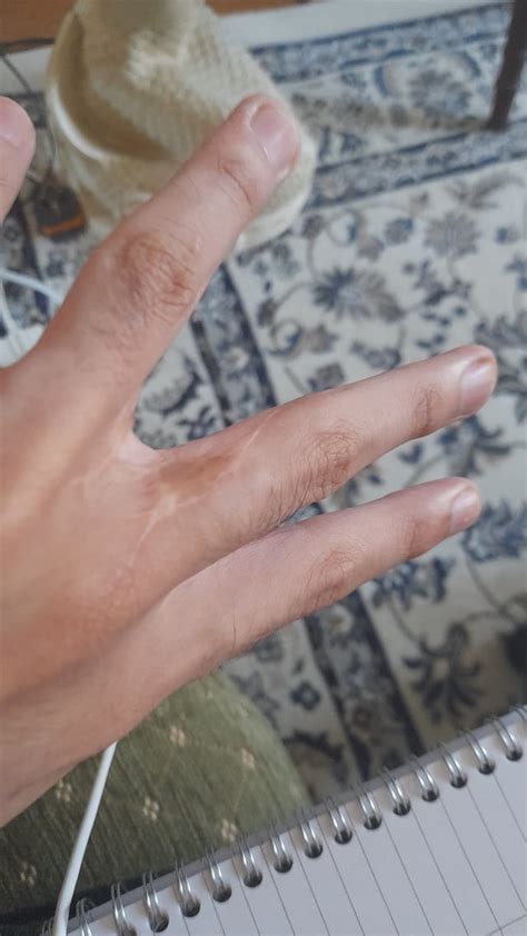 Scars From A Birth Defect I Was Born With Webbed Fingers Rhands