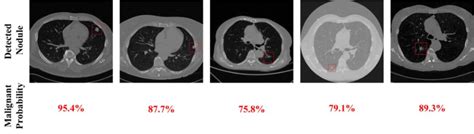 Visualization Of Nodule Classification Results On Test Set Download Scientific Diagram