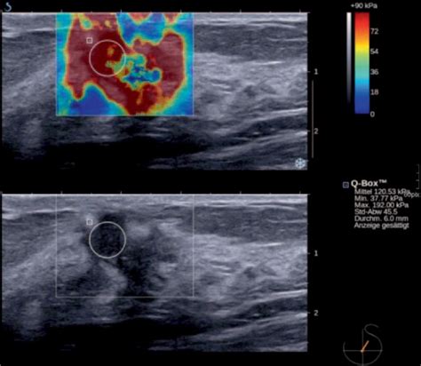 Breast Sonography 2d 3d 4d Ultrasound Or Elastography Pmc