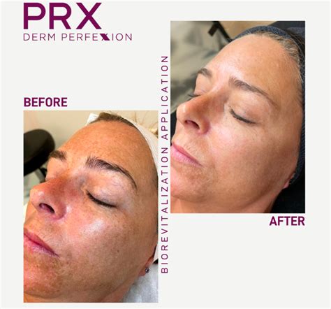 Prx Derm Perfectionprx Plus Chelmsford Ma Begin With Skin Med Spa