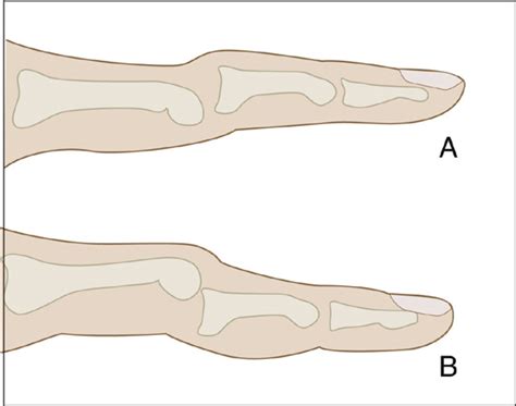 Finger Dislocation Pip Joint Anesthesia Key