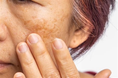 Effective Melasma Treatment Iksana Wellness