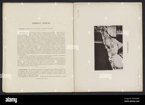 Patient Suffering From The Skin Disease Pemphigus Vegetans C 1888