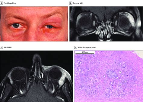 Idiopathic Dacryoadenitis Download Scientific Diagram