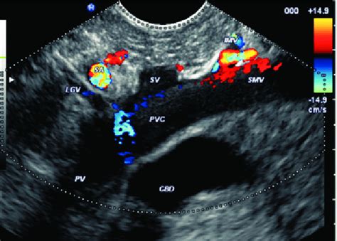 Superior Mesenteric Vein Ultrasound