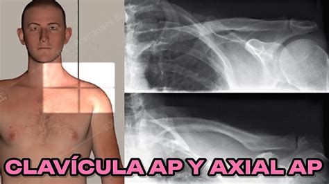 Rx Clavicula Normal A Visual Guide Everyone Should See Learnfastblog