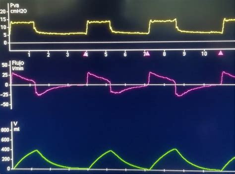 Correction Of Delayed Triggering From Top To Bottom Pressure Time