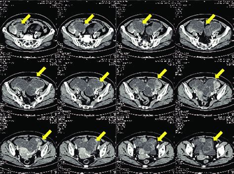 Case 3 Preoperative Computed Tomography Images Download Scientific