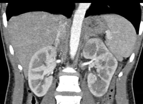 Acute Pyelonephritis With Patchy Nephrogram Best Seen On Late Phase Imaging As Well As Arterial