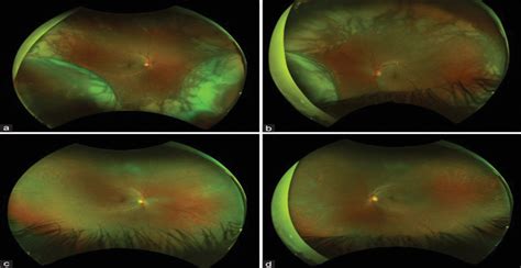 Bilateral Acute Retinal Necrosis With Choroidal Detachment Indian