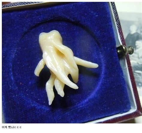 사랑니 레전드 ㄷㄷ ㅎㅇㅈㅇ 인스티즈 Instiz 일상 카테고리