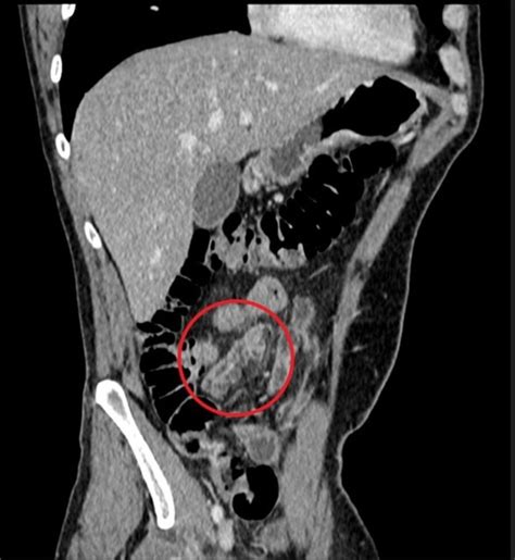 Acute Diverticulitis Of The Appendix Bmj Case Reports