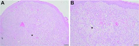 Capillary Malformation A Low Power 4 Â View Shows The Increased