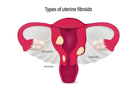 What Is Intramural Fibroid Causes Symptoms And Treatment