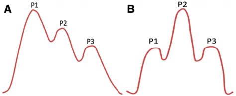 Intracranial Pressure Monitoring Indications Types Teachmesurgery