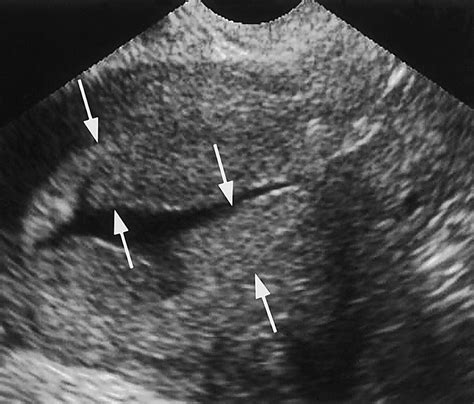Thickened Endometrium Radiology At Maddison Rosenthal Blog