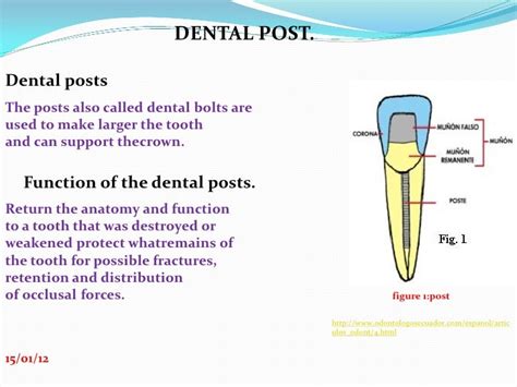 What Is A Dental Post Procedure At Catherine Fletcher Blog