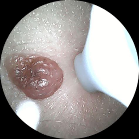 Do These Moles Look Cancerous R Dermatology