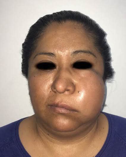 Cellulitis By Dr Gourav Sharma Painless Dental Surgeon