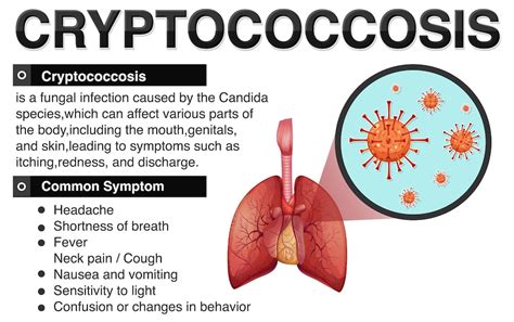 Cartel Informativo De Criptococosis Vector Gratis