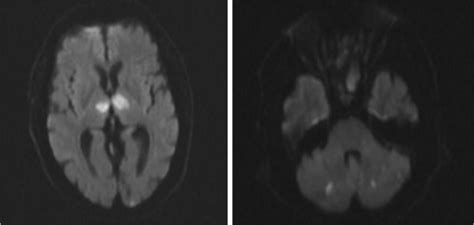 Diffusion Weighted Imaging Showing Multiple Punctate Foci Of Restricted Download Scientific
