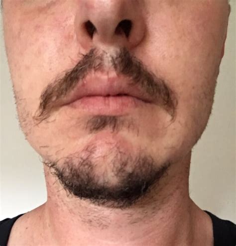 Beard Journey Update Weak Cheeks Beard Board