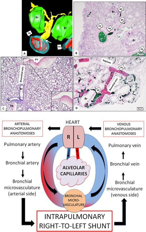 Intrapulmonary Vascular Shunt Pathways In Alveolar Capillary Dysplasia