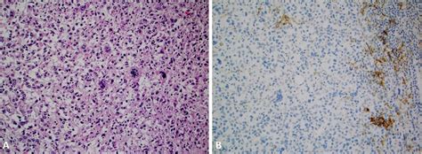 Figure 2 From Pd L1 Testing By Immunohistochemistry In Immuno Oncology Semantic Scholar