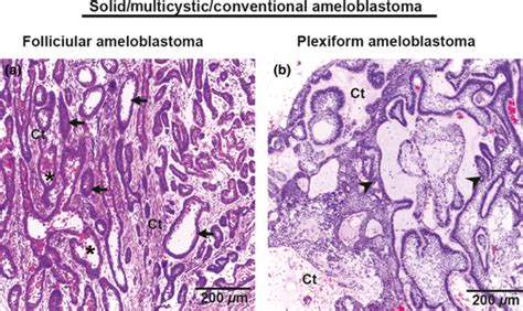 Plexiform Ameloblastoma Histology Plexiform Ameloblastoma Histology