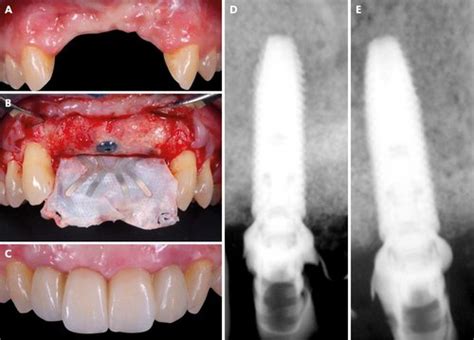 3 Key Protocols For Horizontal And Vertical Bone Defects Geistlich