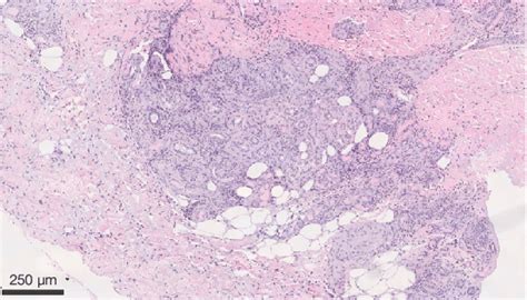 Hande Section Shows The Deep Aspects Of The Dermis With Vasculitis With