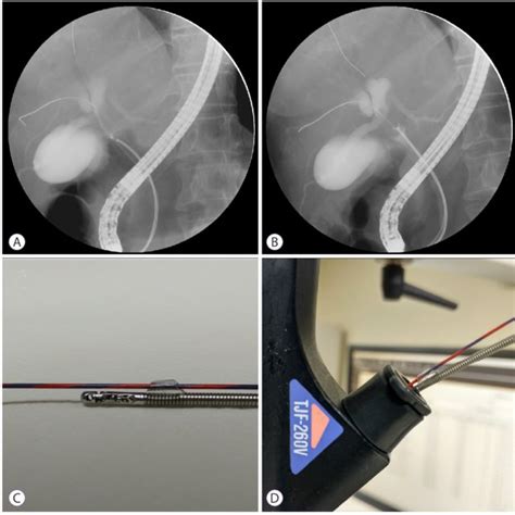 A Cholangiography Shows An Irregular Filling Defect In The Proximal