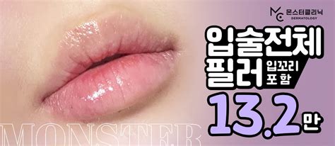 입술 입꼬리 전체필러 뀨x By 몬스터의원 강남언니 1등 성형수술and피부시술 정보앱