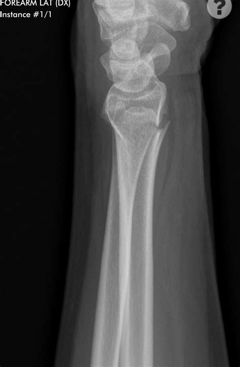 Broken Distal Radius Raskdocs Broken Distal Radius Raskdocs