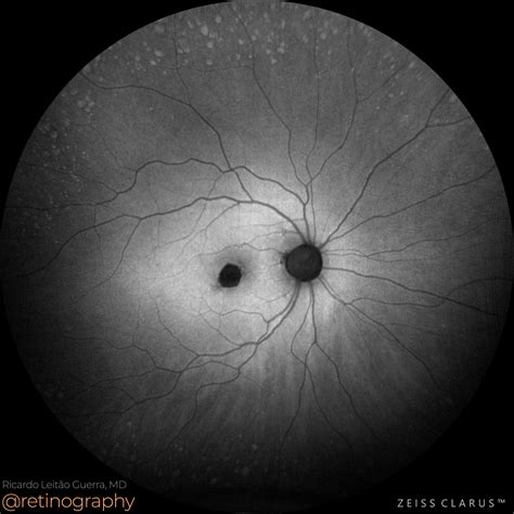 Central Areolar Choroidal Dystrophy Retinography