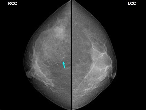 Atlas Of Breast Cancer Early Detection