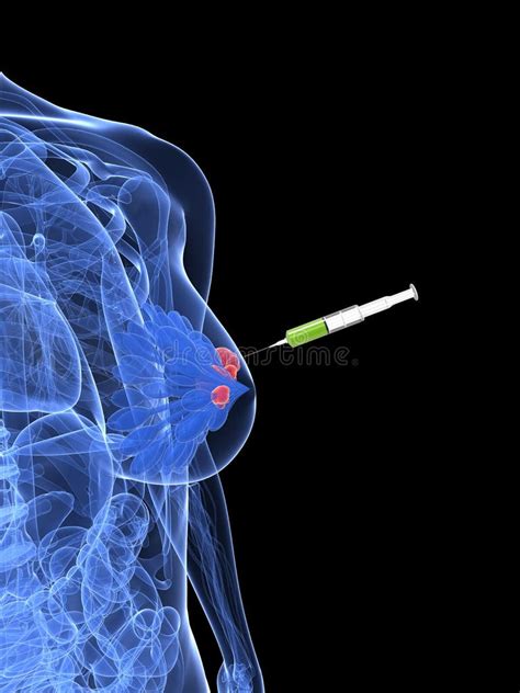 Breast Biopsy Stock Illustrations 211 Breast Biopsy Stock