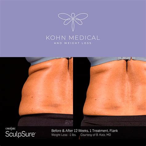 Sculpsure Before And After Photos Real Patient Results