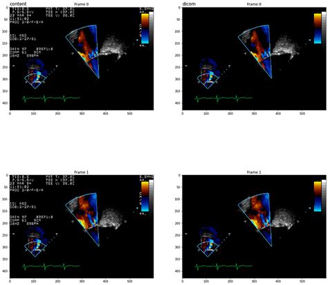 Dicom De Identification At Scale In Visual Nlp 33 John Snow Labs
