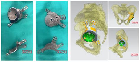 3 Striking Real Cases Of Metal 3d Printing In Surgery And Medicine