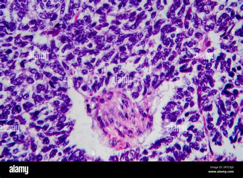 Wilms Tumor Or Nephroblastoma Light Micrograph Photo Under Microscope High Magnification