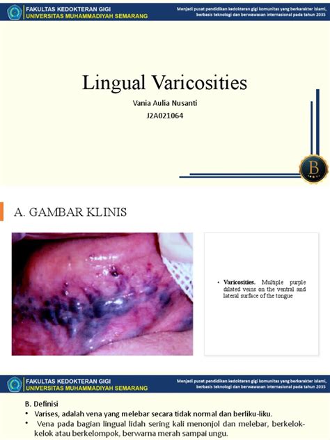 Lingual Varicosities Pdf