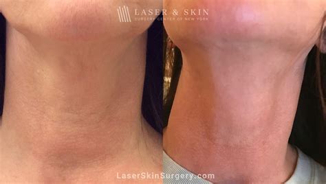Does Botox Work For Neck Sagging Expert Dermatologists Reveal Laser Ny