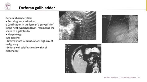 Cholelithiasis Full Description Radiology Pptx